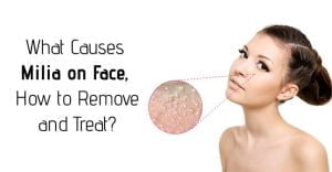 What Causes Milia on Face, How to Remove and Treat?